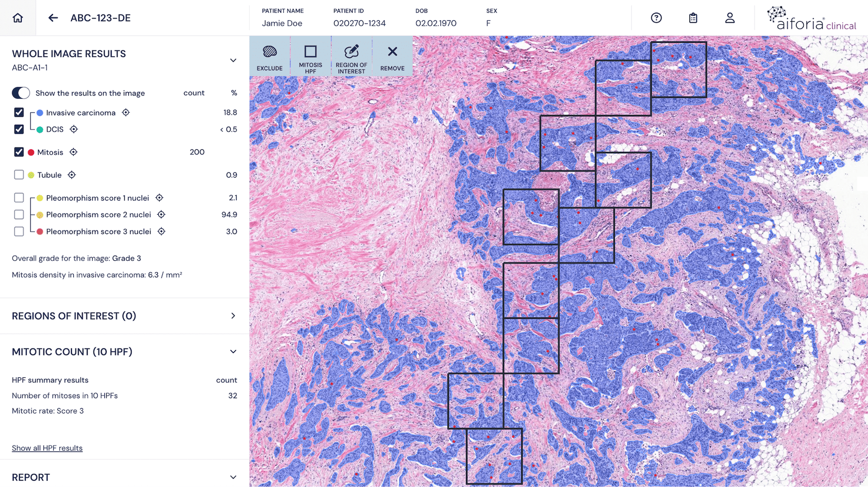 Harmony on the horizon – could AI standardize breast cancer grading?