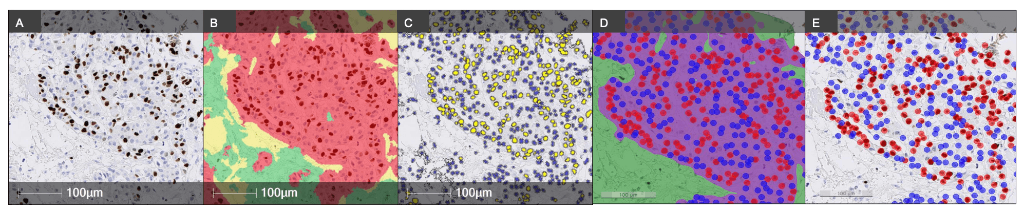 Cerba Research case study: utility of AI in Ki-67 scoring of breast cancer