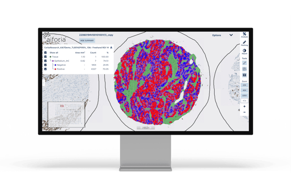 Cerba Research case study: utilizing AI in Ki-67 quantification in ...