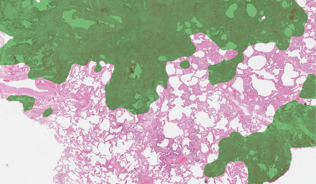 Case study: differentiating interstitial lung disease subtypes using AI ...