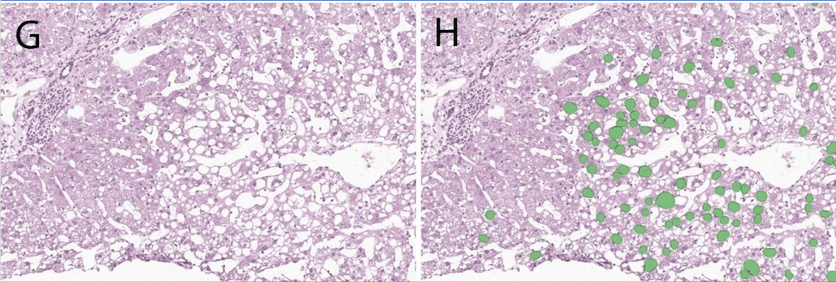 Case study: AI model can improve large droplet fat quantitation in ...