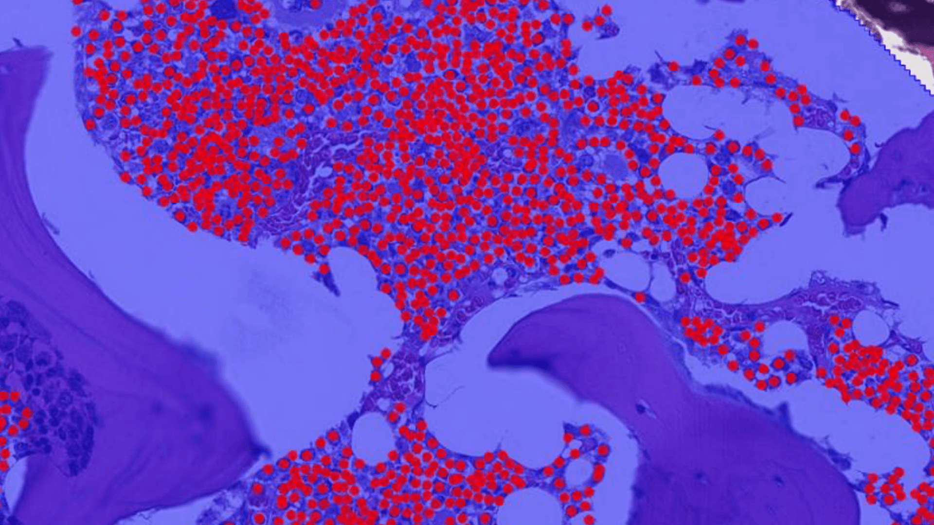 CRL case study: AI-assisted screening of bone marrow cellularity changes